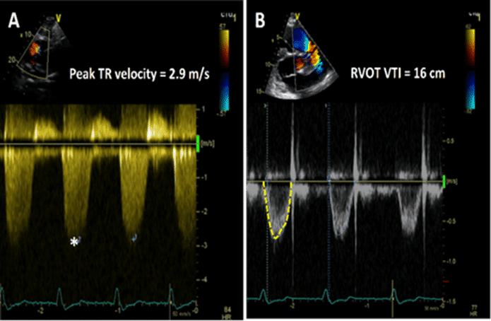 Pulmonary Vascular Resistance - Dr. Ghazal
